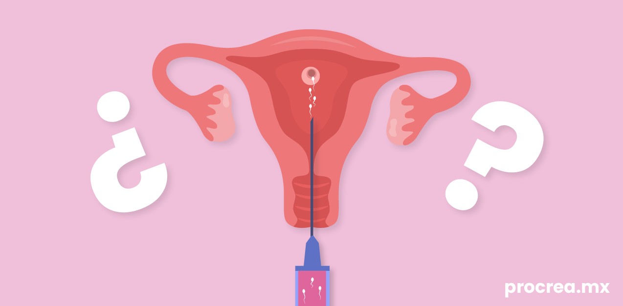 Inseminación intrauterina: ¿Cuándo es una opción? | Procrea